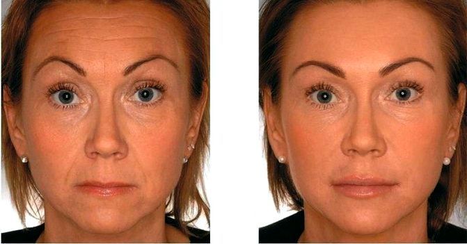 REFINEX Botulinum Toxins & Dermal Fillers | QMed BioTech Corp