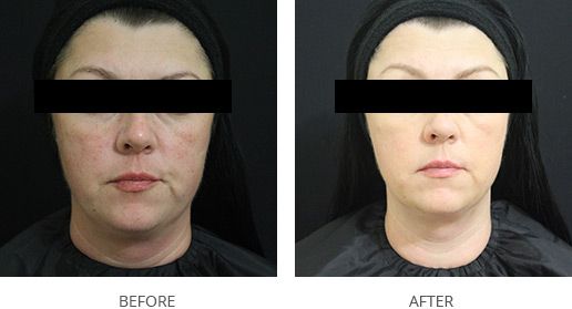 Aquashine BTX | Caregen S.Korea
