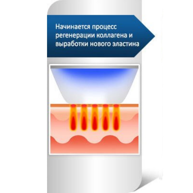 Фракционный RF secret аппарат